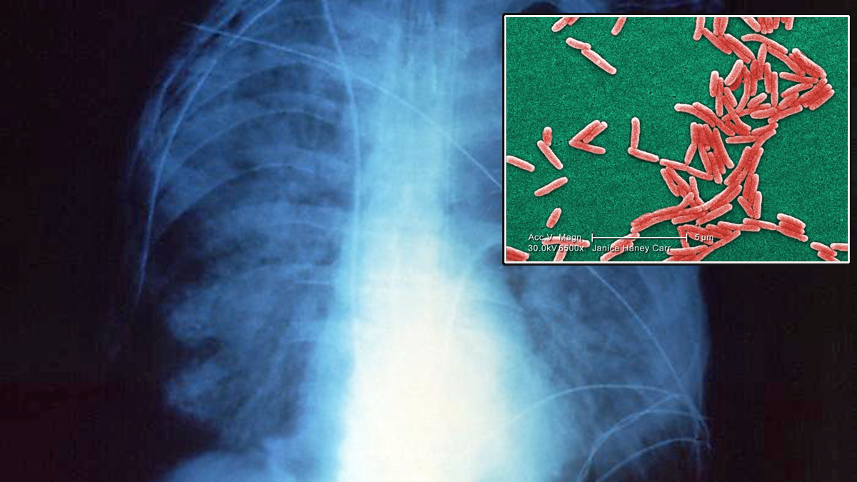 What is Legionnaires’ disease? – NBC Bay Area