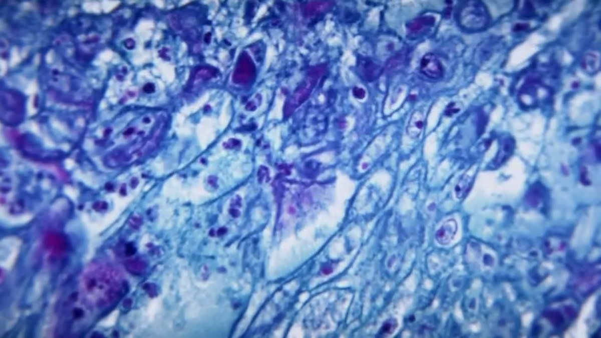 Probable Case of Monkeypox in Santa Cruz County – NBC Bay Area