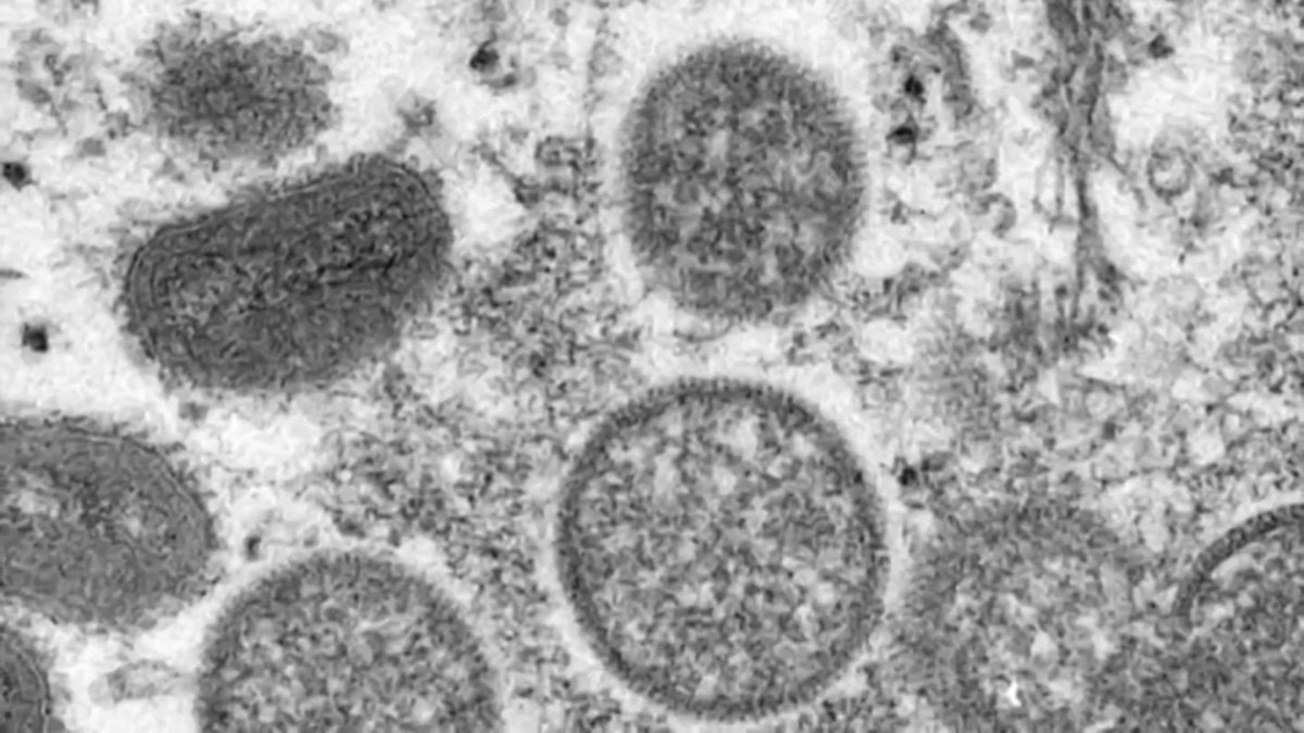 Interview: UCSF Doctor Breaks Down Latest Monkeypox Developments – NBC ...