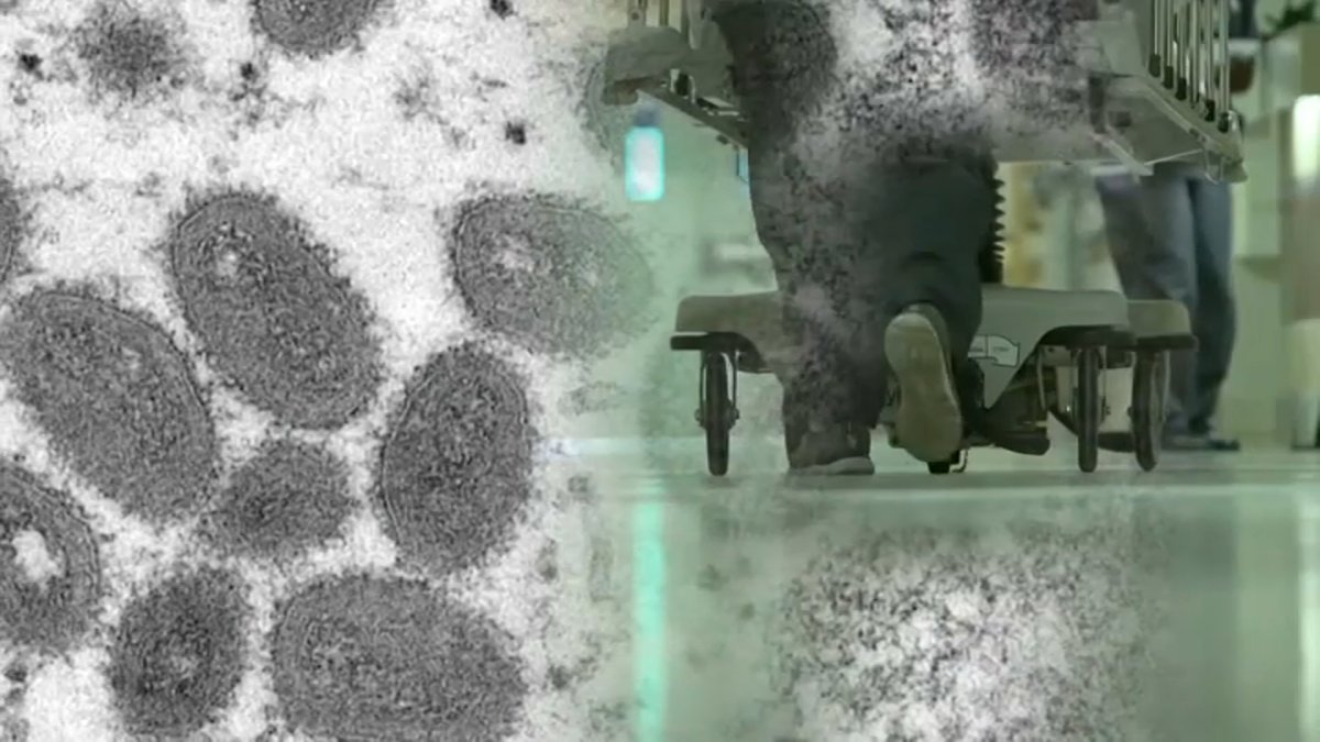 Monkeypox Vaccines Not Enough for Growing Demand in San Francisco – NBC ...