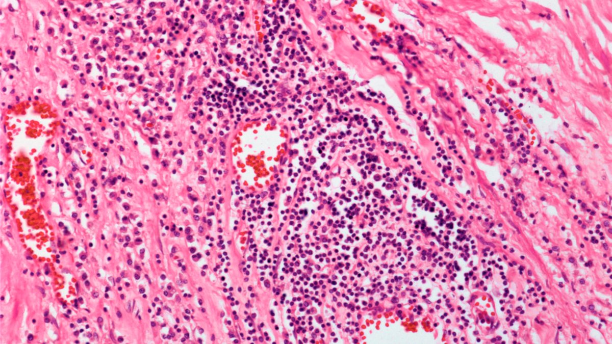 ‘Out of Control’ Cases for STDs, Including Gonorrhea and Syphilis ...