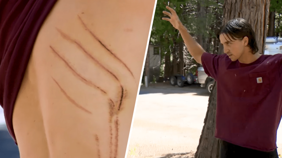 Man survives bear attack in California – NBC Bay Area