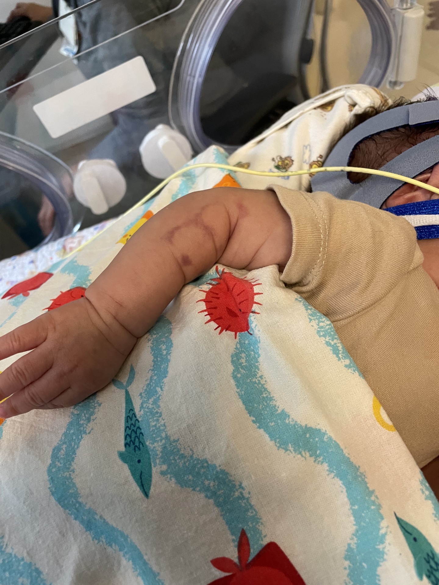 Criminal probe into bruises on babies at Oakland hospital – NBC Bay Area