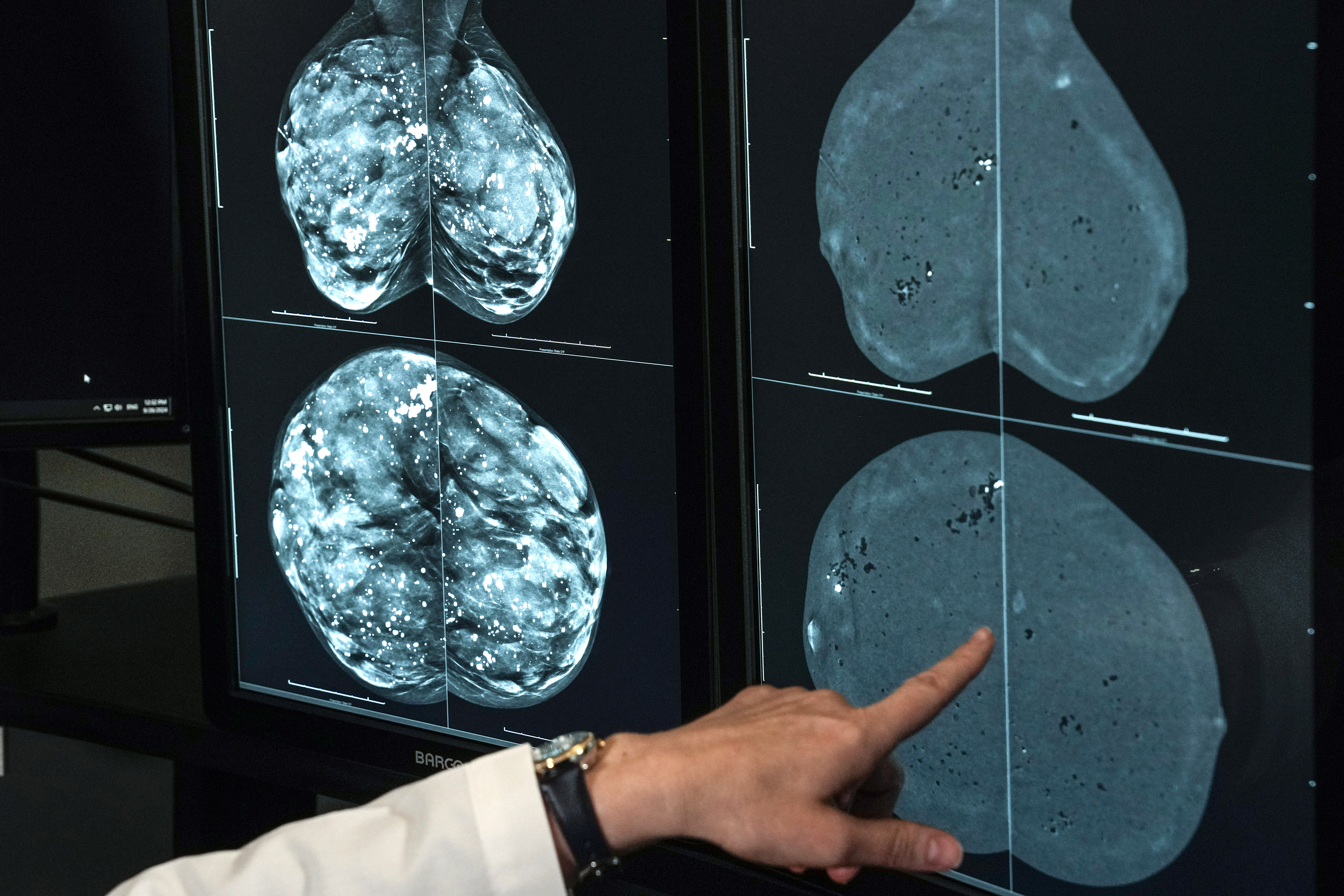 This is when you should get a mammogram – NBC Bay Area